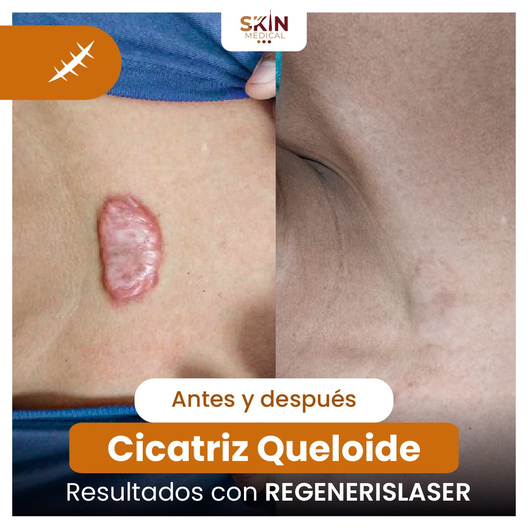 Cómo Aplanar O Eliminar Cicatriz Queloide